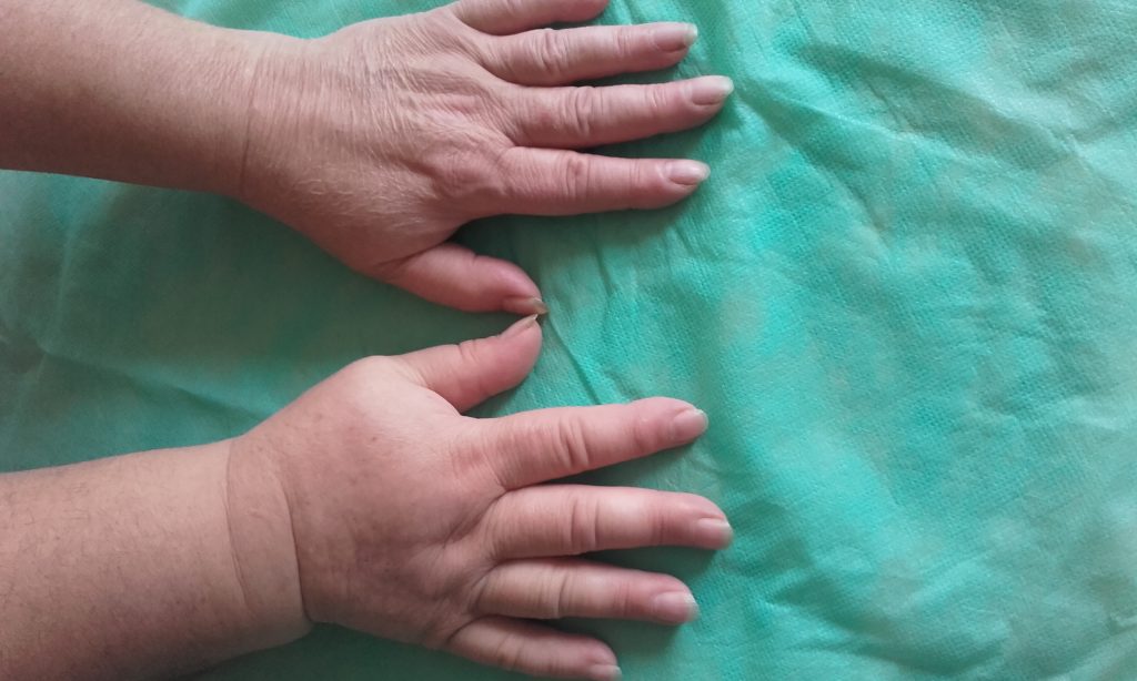 Limfedem ruke nakon operacije dojke - MANUAL MED